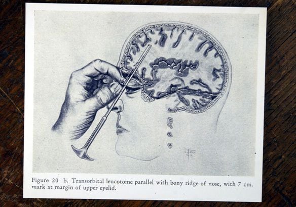 Lobotomy Diagram