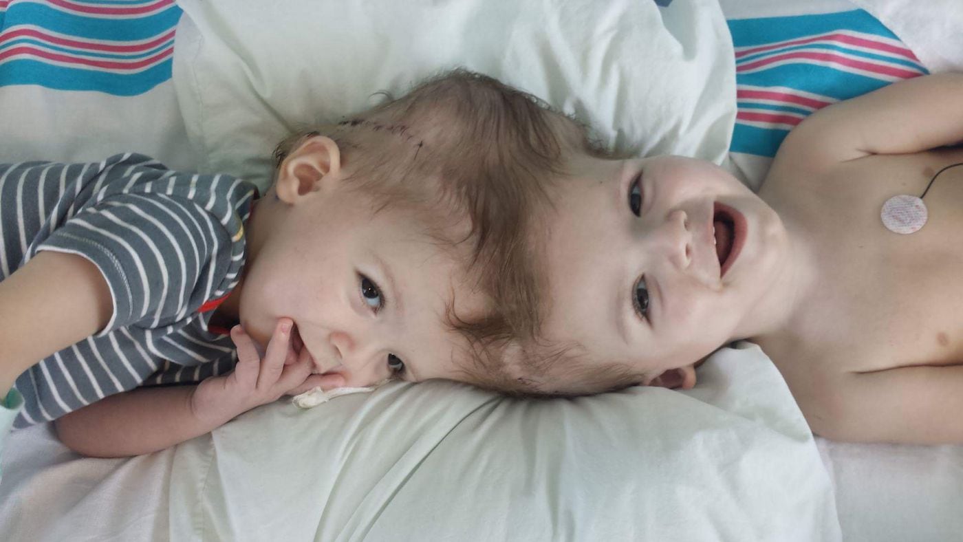 Separating conjoined twins 'only the beginning' of challenges