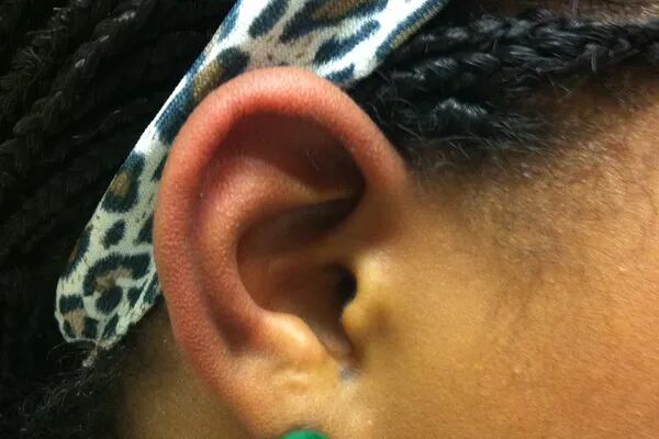 Medical mystery: A girl’s red ears, a mother’s intuition