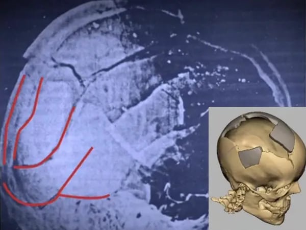 Lee Harvey Oswald Skull