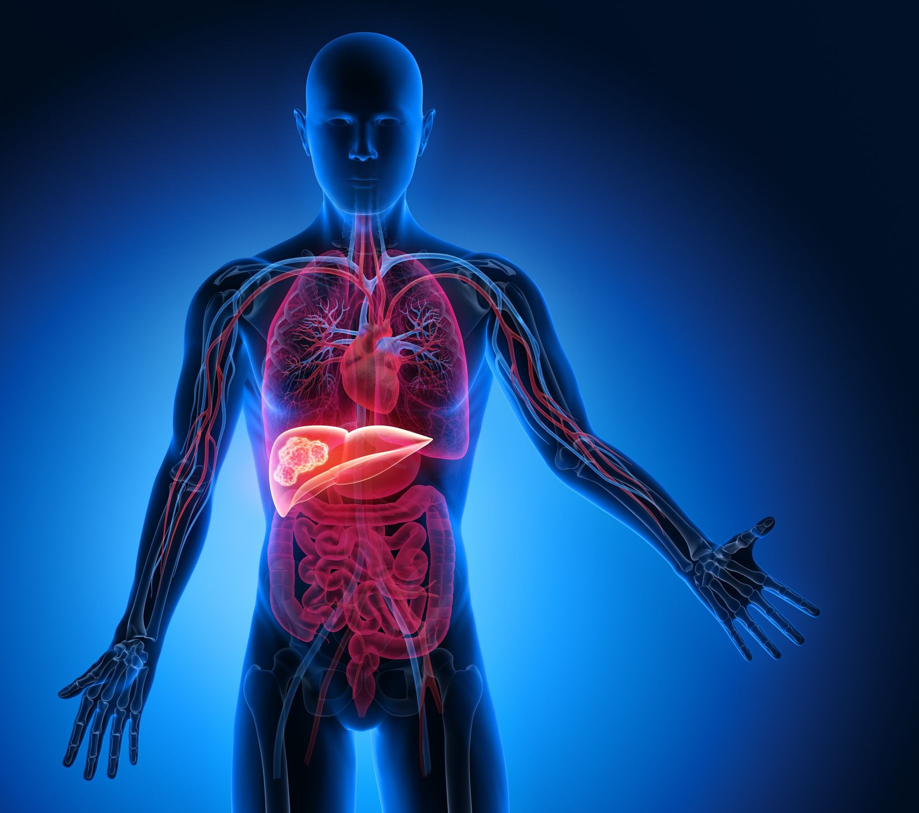 Real Human Liver Cancer