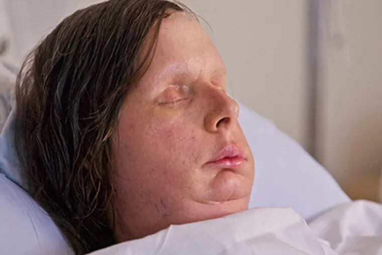 Woman chimp mauled shows off her new face