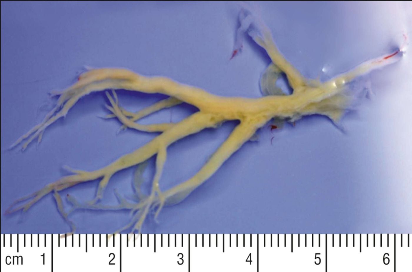 Philly docs solve riddle of patients who cough up ‘tree branches’