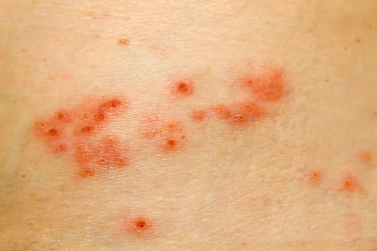 Shingles On Shoulder