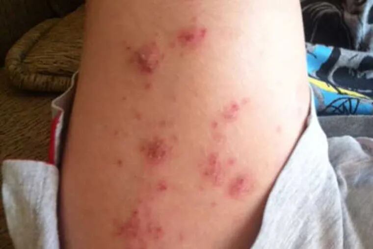 An itchy rash torments child, puzzles doctors